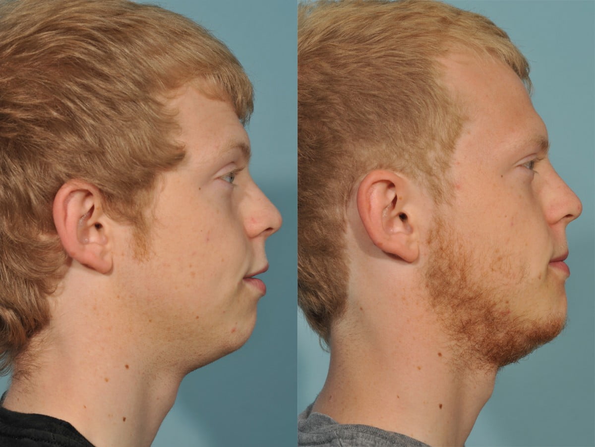 Chin Implants Jesse E Smith MD FACS Ft Worth Colleyville Facial Chin Implants Jesse E Smith MD FACS Ft Worth Colleyville Facial
