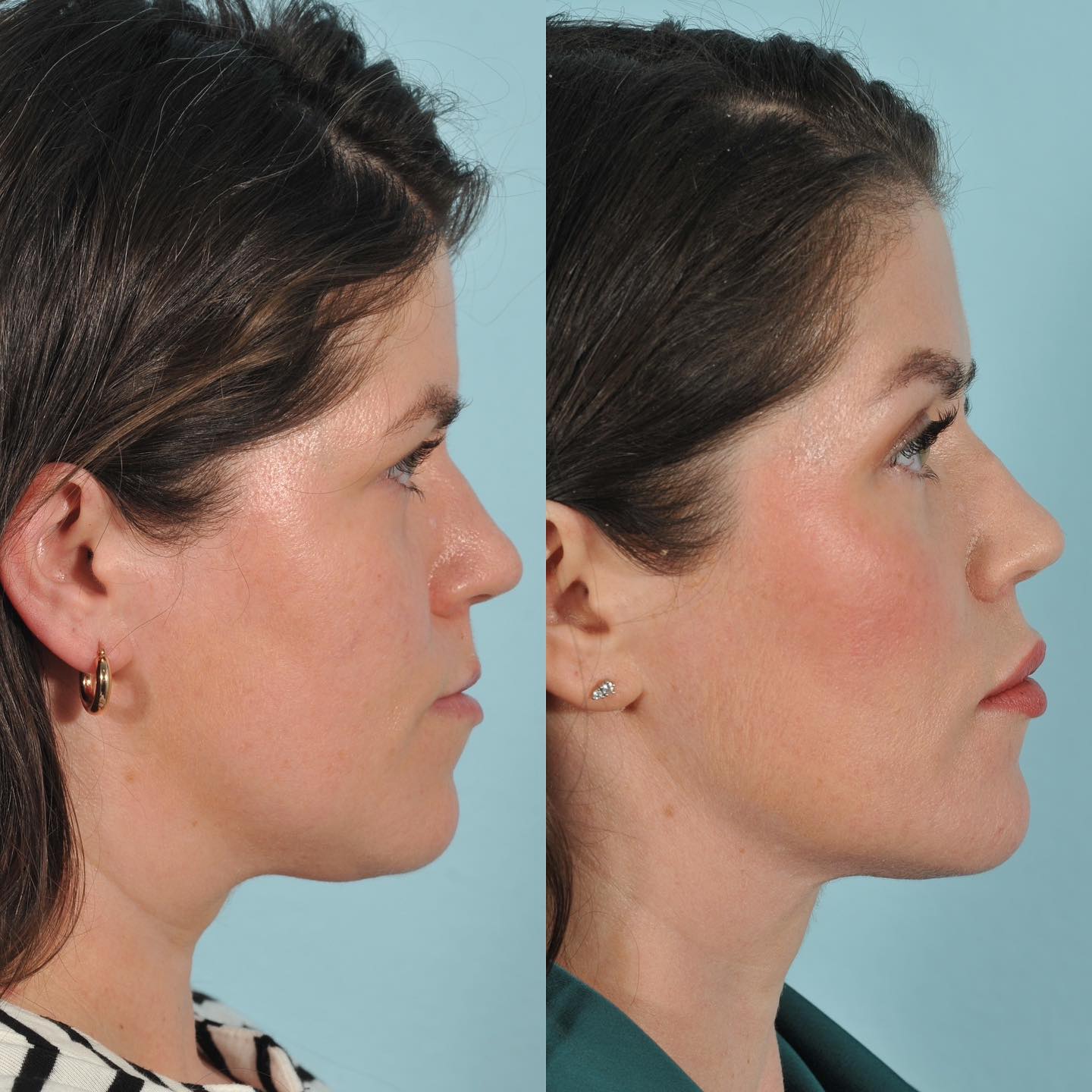 Injectables Before & After #12