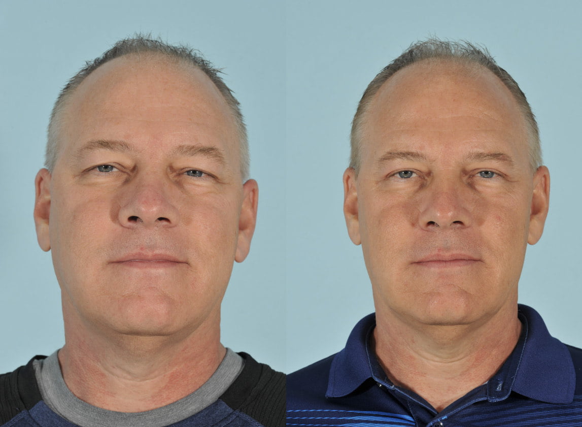 Blepharoplasty Before & After #3