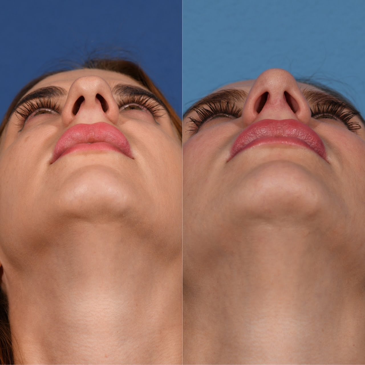 Preservation Rhinoplasty Before & After #18