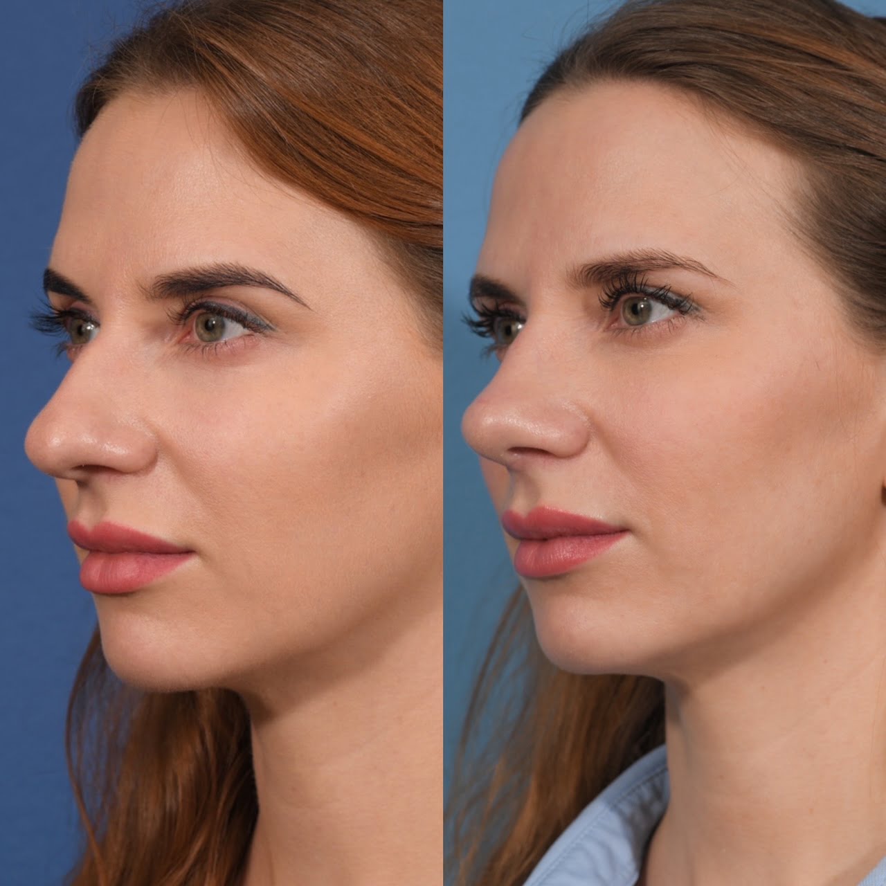 Preservation Rhinoplasty Before & After #18