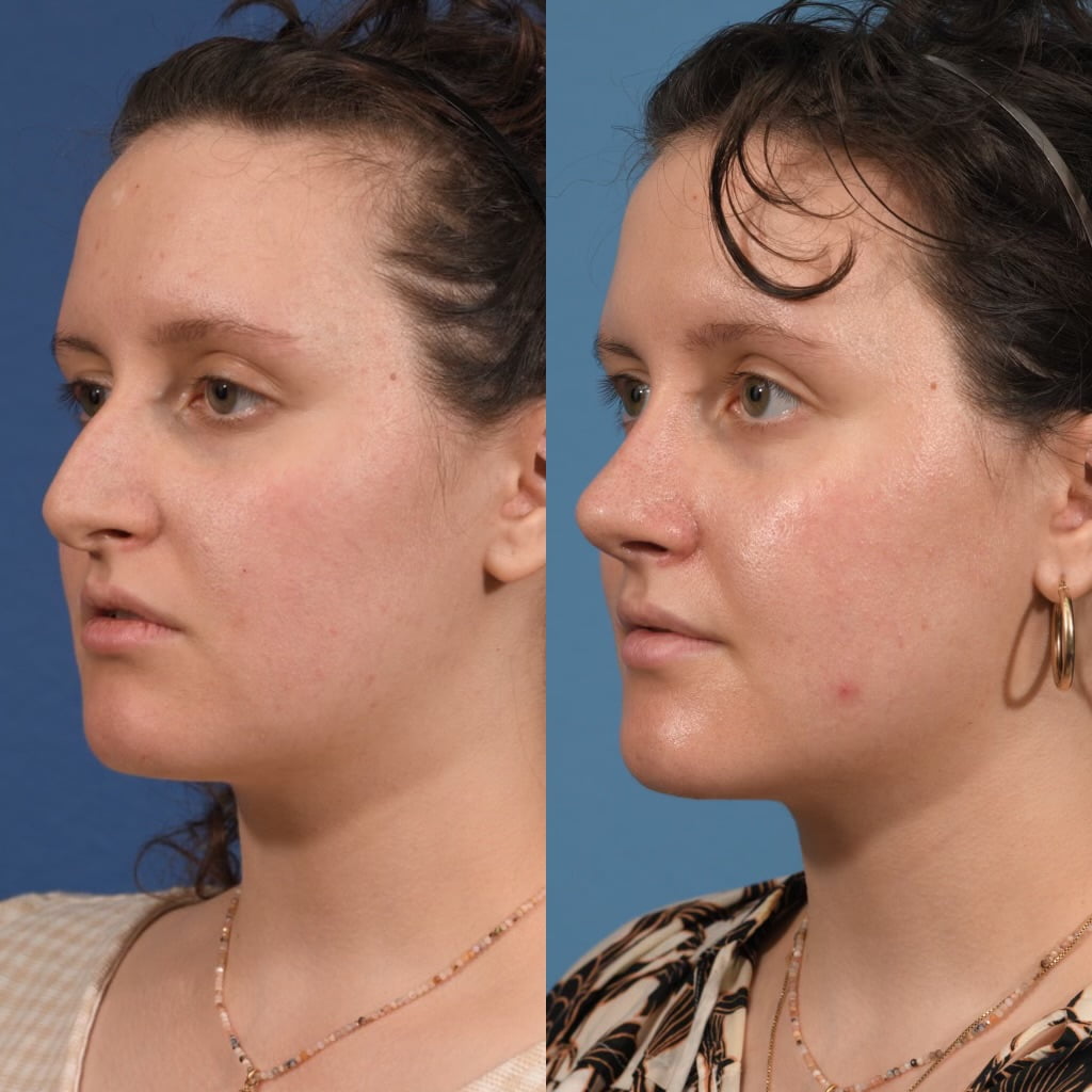 Septoplasty Before & After #20