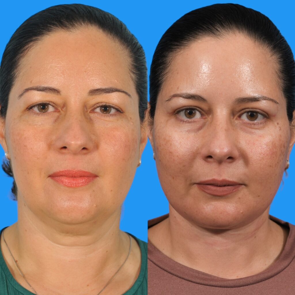 Upper Blepharoplasty: Before and After Care Tips